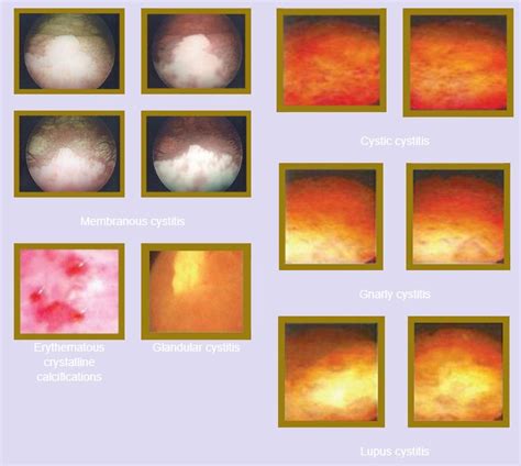 Chronic Cystitis Diagnosis Georgiadis Urology