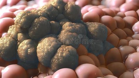 The Proliferation Of Cancer Cells Illustration Stock Illustration