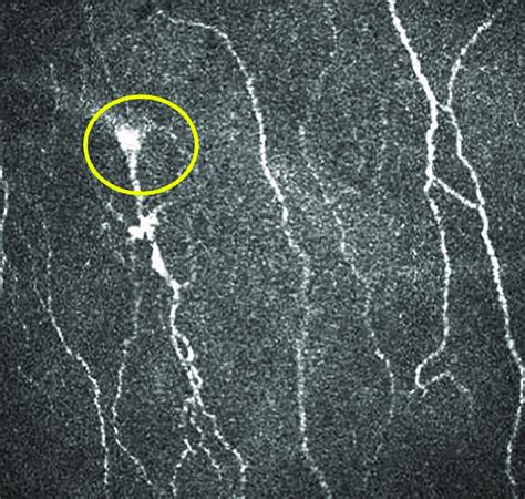 In Vivo Confocal Microscopy Of The Cornea Showing Microneuroma