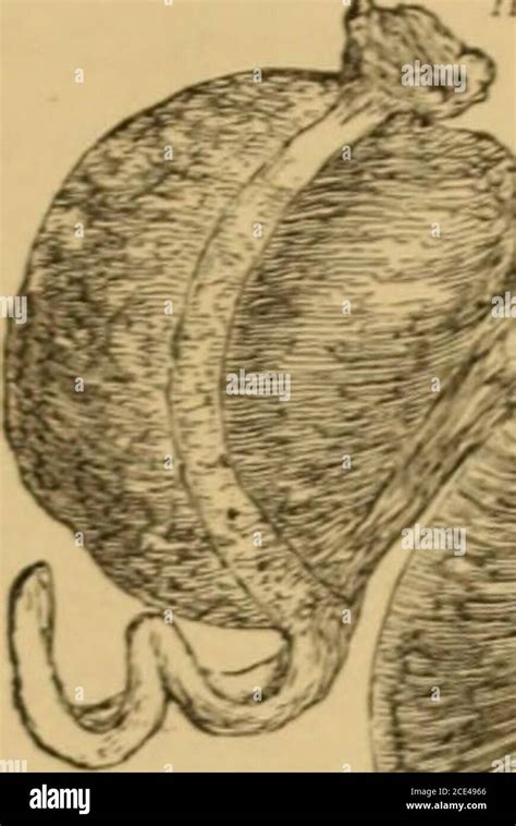 A System Of Obstetrics Sionally Find A Loop Of Intestine Which Had Passedunder The Band And