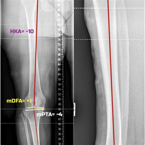Long Limb Radiographs And Alignment Measurements Essential Parameters