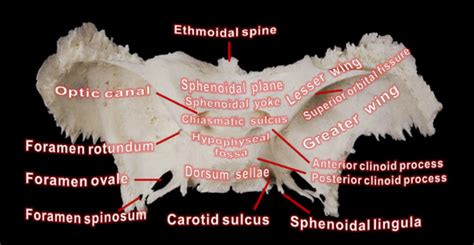 Bony Landmarks Of The Sphenoid Bone Superior View The Arcade Of Four Download Scientific