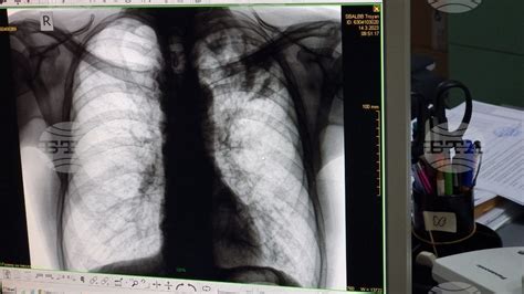 Жителите на 22 те общини в София област ще могат да се прегледат безплатно за туберкулоза в