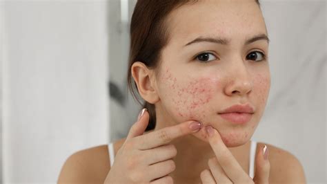Try These Natural Ways To Reduce Acne Marks From Your Face