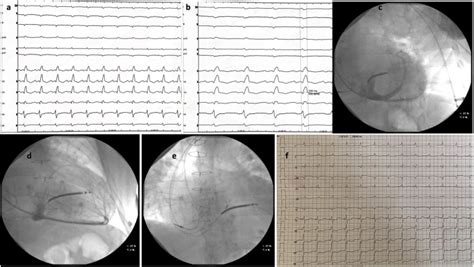 Cardiac Resynchronization Therapy With Conduction System Pacing In A Long Term Heart Transplant