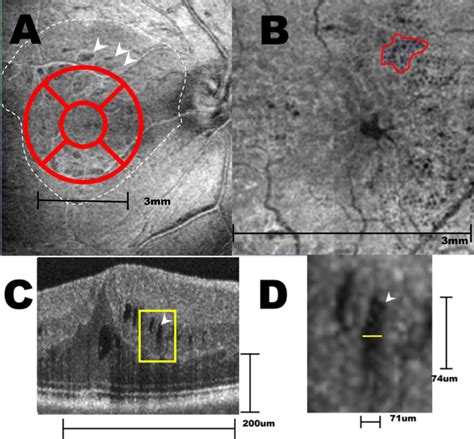 Inner Nuclear Layer Microcyst Configuration Distribution And Visual Prognosis In Patients With