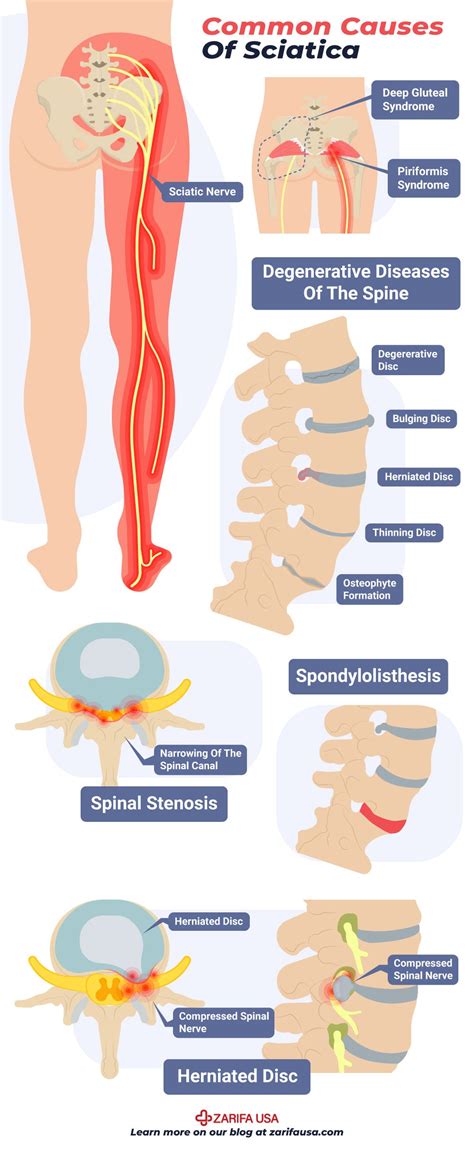 Understanding Sciatica Causes Symptoms And Treatment Options