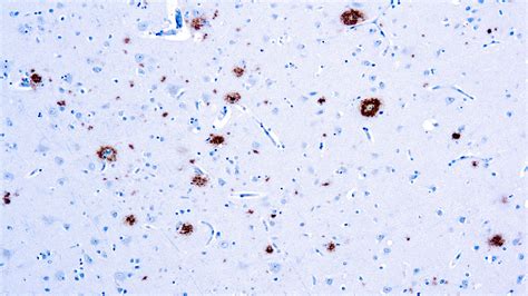 Amyloid Beta Protein Amyloid Beta Protein Ihc Buy Now Abcepta