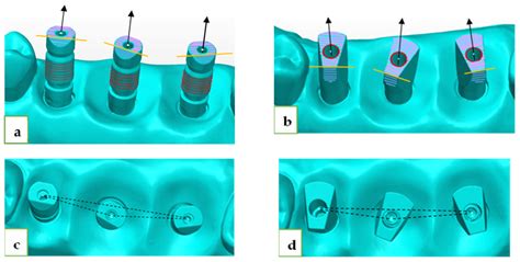 The Mean Intra Implant Distance Central Points 1 2 3 Error And ±sd