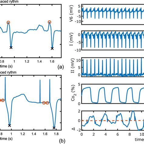 Extraction Of The Beat Wise Qrs Amplitude In A Native Heart Rhythm