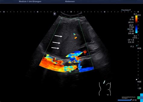 Budd Chiari Syndrome Atlas Of Ultrasound