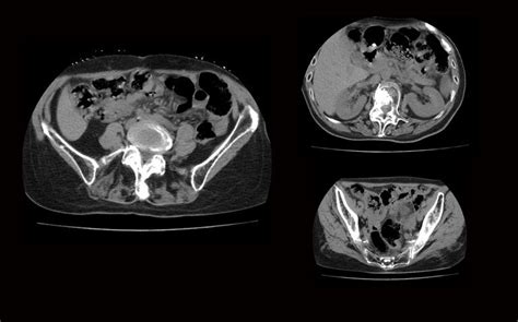 Cnn Model Improves Orthopaedic Surgeons Detection Of Ct Scan Fractures