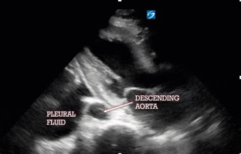 Subxiphoid Pericardial Window
