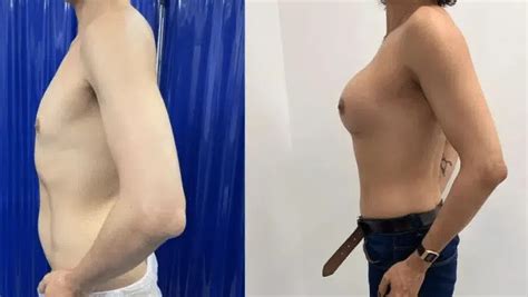 Do I Still Need To Wear A Bra After Breast Augmentation Centre For