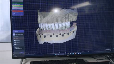 3D Denture Model Design Using Computer Software Stock Video Video Of