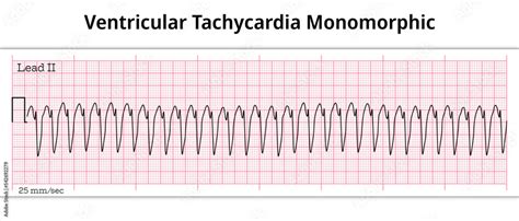 Ecg Ventricular Tachycardia Monomorphic Vt 8 Second Ecg Paper Stock