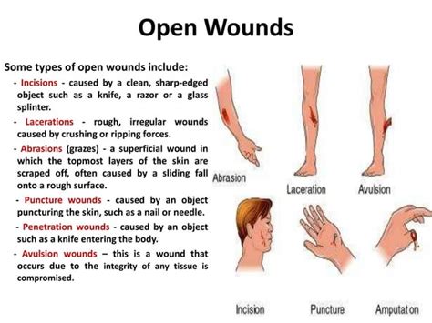 Controlling External Bleeding Pptx First Aid Injuries