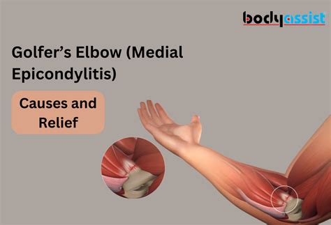 Medial Epicondylitis Golfers Elbow The Shoulder And Elbow Clinic