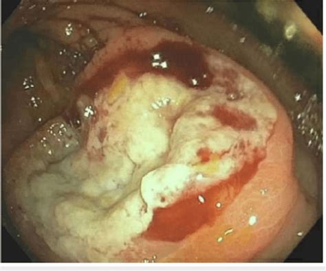 Mucosal Ulceration In Appendiceal Orifice Picture Taken From