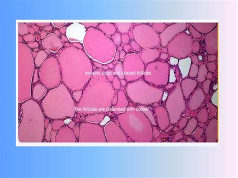 Multi Nodular Goitre Mbbs 3rd Year Pptx