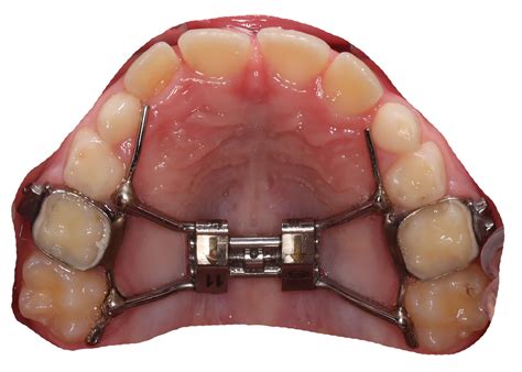 Rapid Palatal Expander Palate Expander Yang Orthodontics