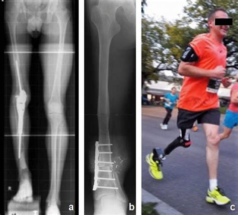 A Radiograph Of Failed Proximal Tibia Megaprosthesis With Limb Length