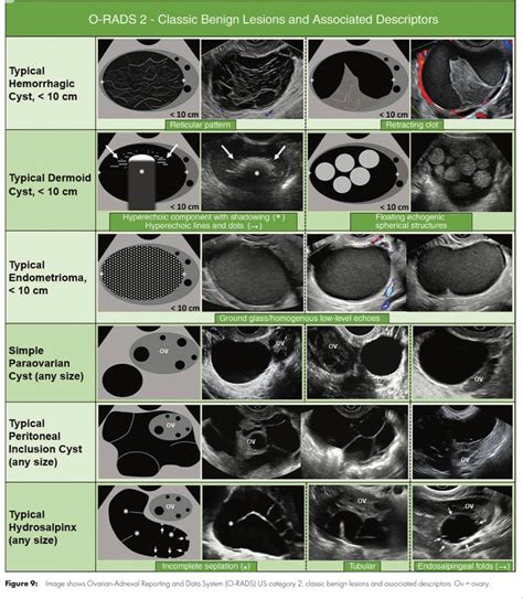 O Rads Us Risk Stratification And Management System A Consensus Guideline From The Acr Ovarian
