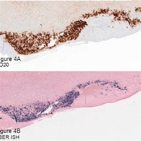 Cd20 Ihc 4a And Eber Ish 4b On Recurrent Lymphoma Tissue