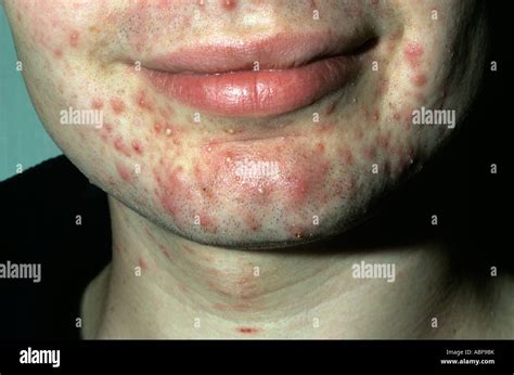 Pustules Hi Res Stock Photography And Images Alamy