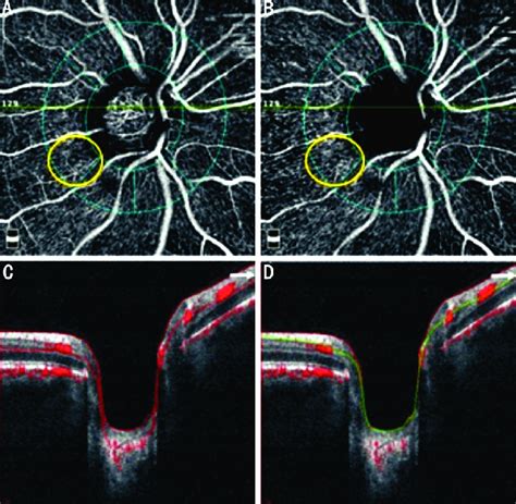En Face Oct Angiography Of The Onh Segmentation A The Rpc Download Scientific Diagram