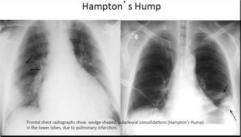 Pulmonary Embolism Flashcards Quizlet