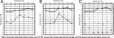 Figure 1 From Pediatric Internal Auditory Canal Cavernous Hemangioma With Rapid Progression Of