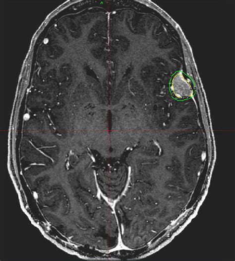 Leksell Gamma Knife© Radiosurgery Plan Of A Left Frontal Meningioma