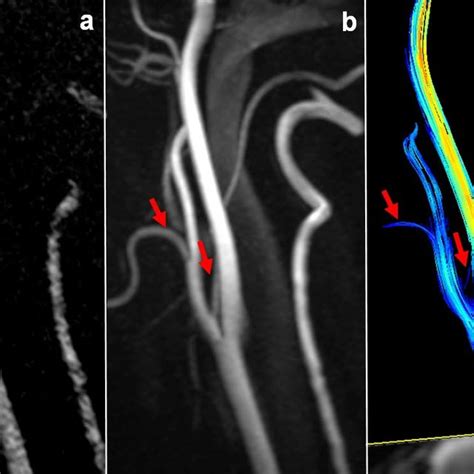 pdf carotid artery imaging at 7t snr improvements using anatomically tailored surface coils