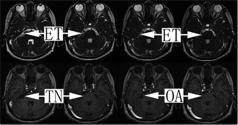 Trigeminal Nerve Mri Protocol