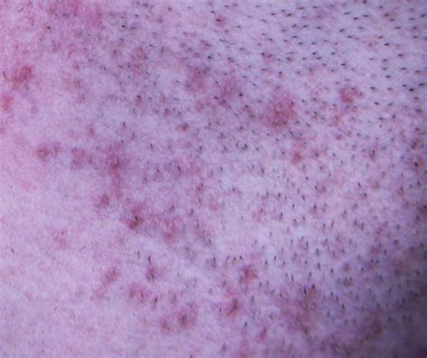 Folliculitis And Furuncles Carbuncles Boils