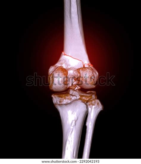 Ct Scan Knee Joint 3d Rendering Stock Illustration 2292042193