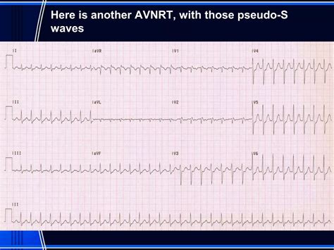 Ecg Approach To Arrhythmias 2017 Ppt Heart And Cardiovascular Diseases Diseases And Conditions