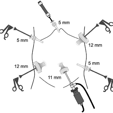 Schematic Diagram Of The Laparoscopic Mini Gastric Bypass Procedure Download Scientific Diagram
