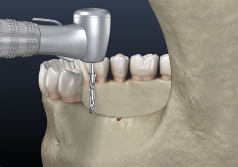 Ridge Augmentation Rebuilding For Dental Implants Chicago Dental