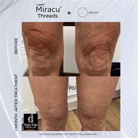 Pdo Threads Bubolo Medical