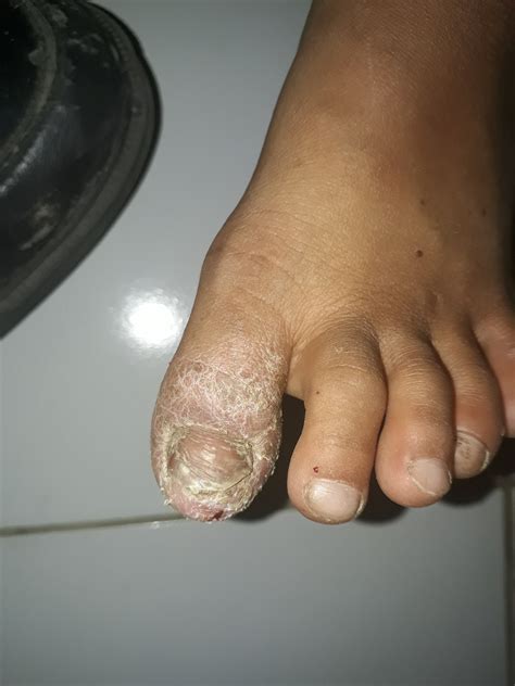 脚趾 皮肤干燥 皮炎 Pixabay上的免费照片 Pixabay