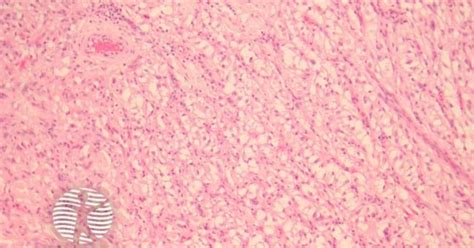 Pecoma Pathology Image