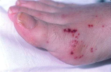 Leukocytoclastic Vasculitis Palpable Purpura That Developed In A