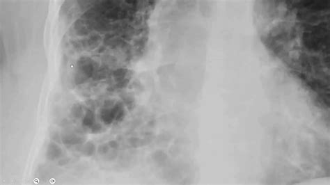 Chest X Ray In Bronchiectasis Findings Radiology Cxr Youtube