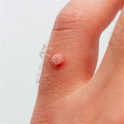 The Treatment And Management Of Viral Warts דר עופר רייטר אגר