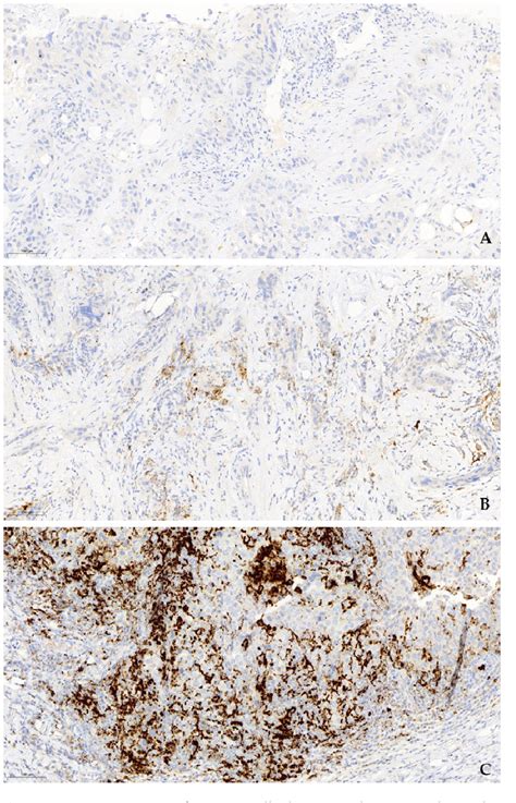 Figure 1 From Pd L1 Positive High Grade Triple Negative Breast Cancer Patients Respond Better To