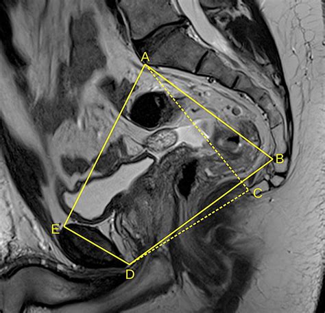 Mri Pelvimetry Reference Points Download Scientific Diagram