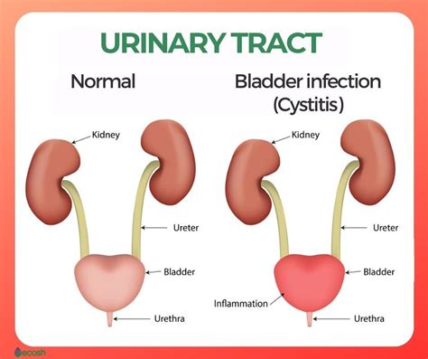 Bladder Infection Cystitis Symptoms Causes And Natural Remedies For Bladder Infection Treatment