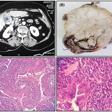 A Abdominal Ct Scan Demonstrating A Gallbladder Mass Measuring 60 Mm